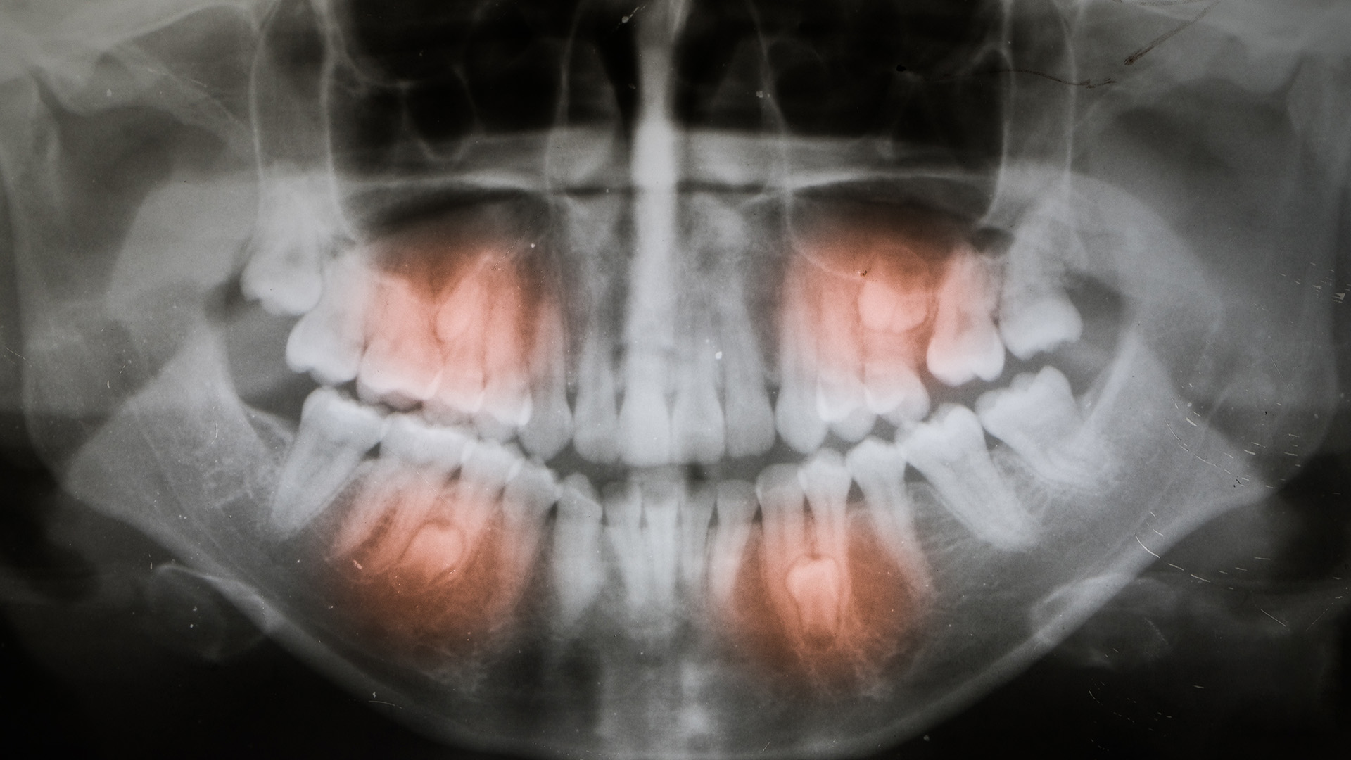 Impacted Teeth in Children: Your Complete Guide | Leap Kid Dental